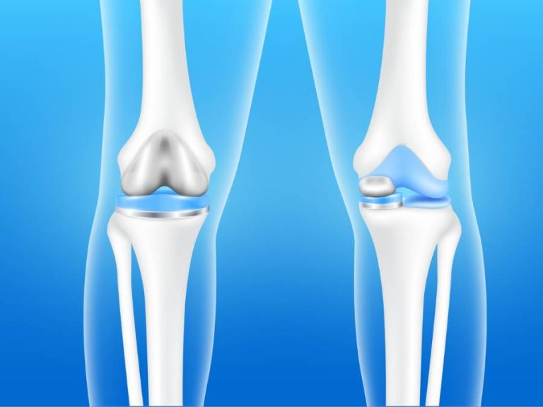 Protesi al Ginocchio: Guida Completa su Tipi, Recupero e Benefici ...
