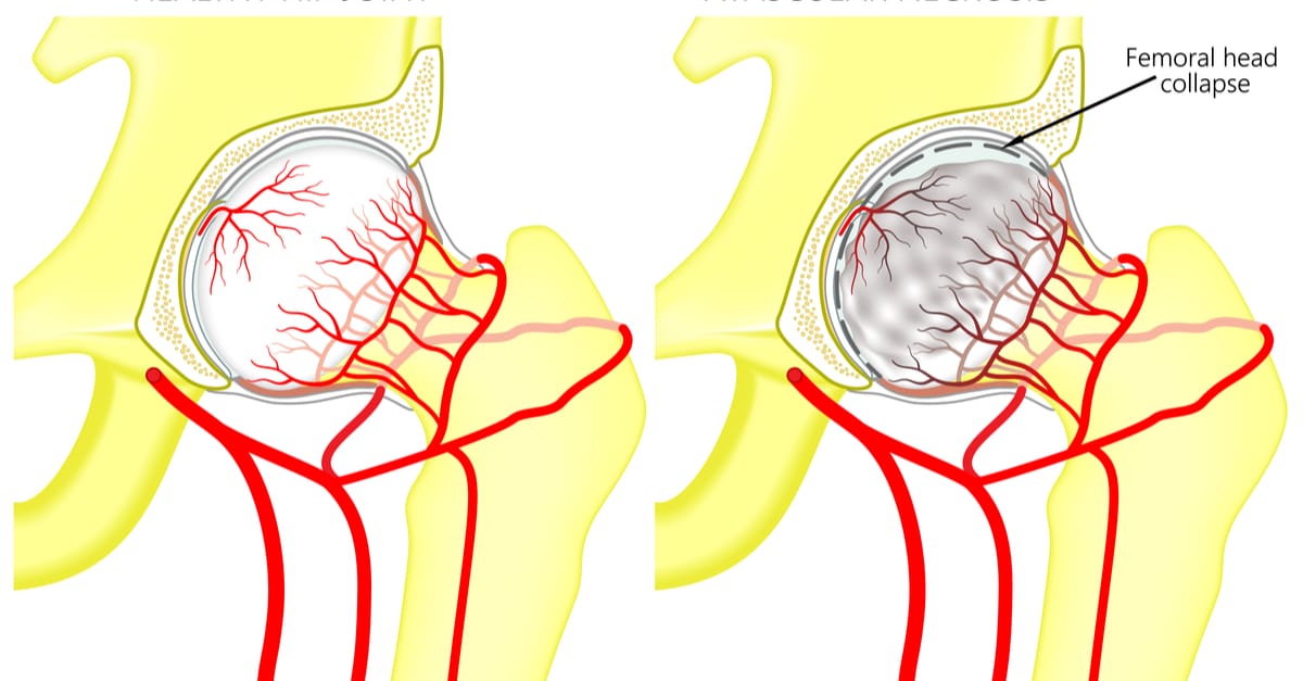 Necrosi Testa Femorale | Ortopedico Dr. Luca Gala