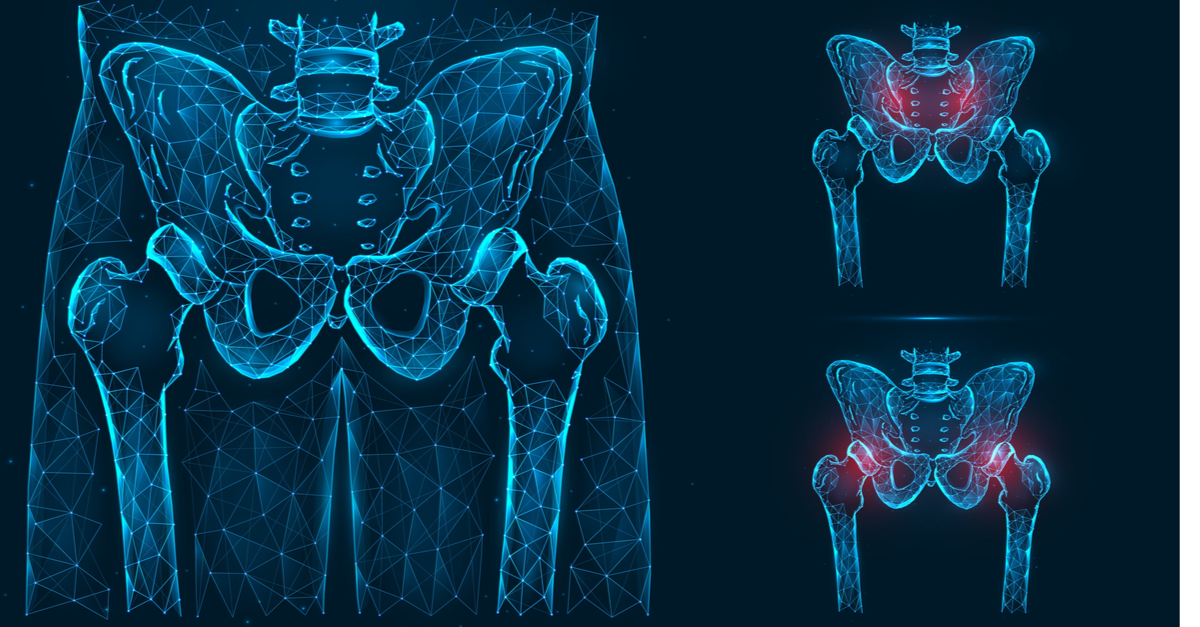 Artrosi anca | Ortopedico Dr. Luca Gala